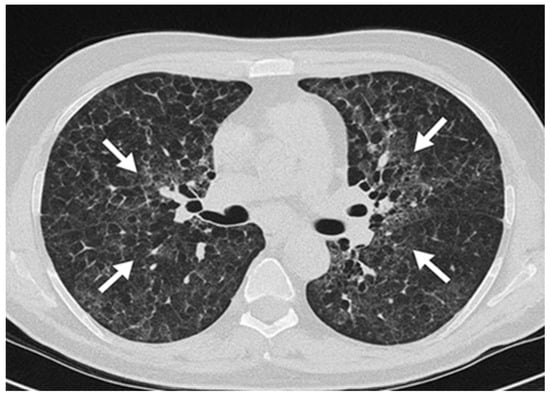 Fibrotic Hypersensitivity Pneumonitis: A Diagnostic Challenge Leading ...
