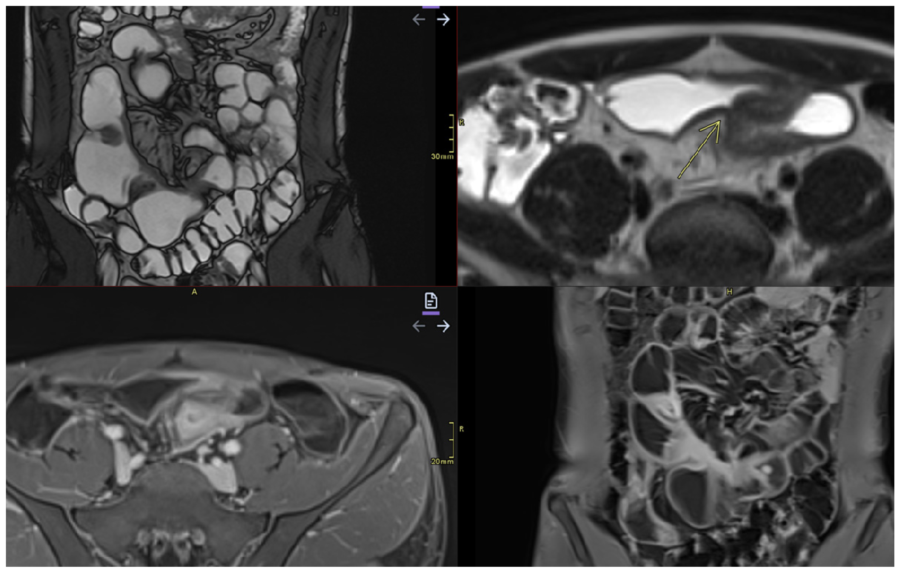 The Importance of Magnetic Resonance Enterography in Monitoring ...