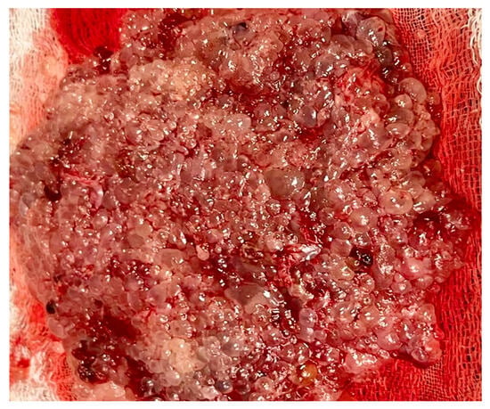 Molar Pregnancy: Early Diagnosis, Clinical Management, and the Role of ...