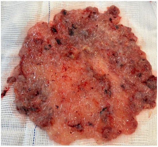 Diagnosis and Surgical Treatment of Hydatidiform Mole | MDPI