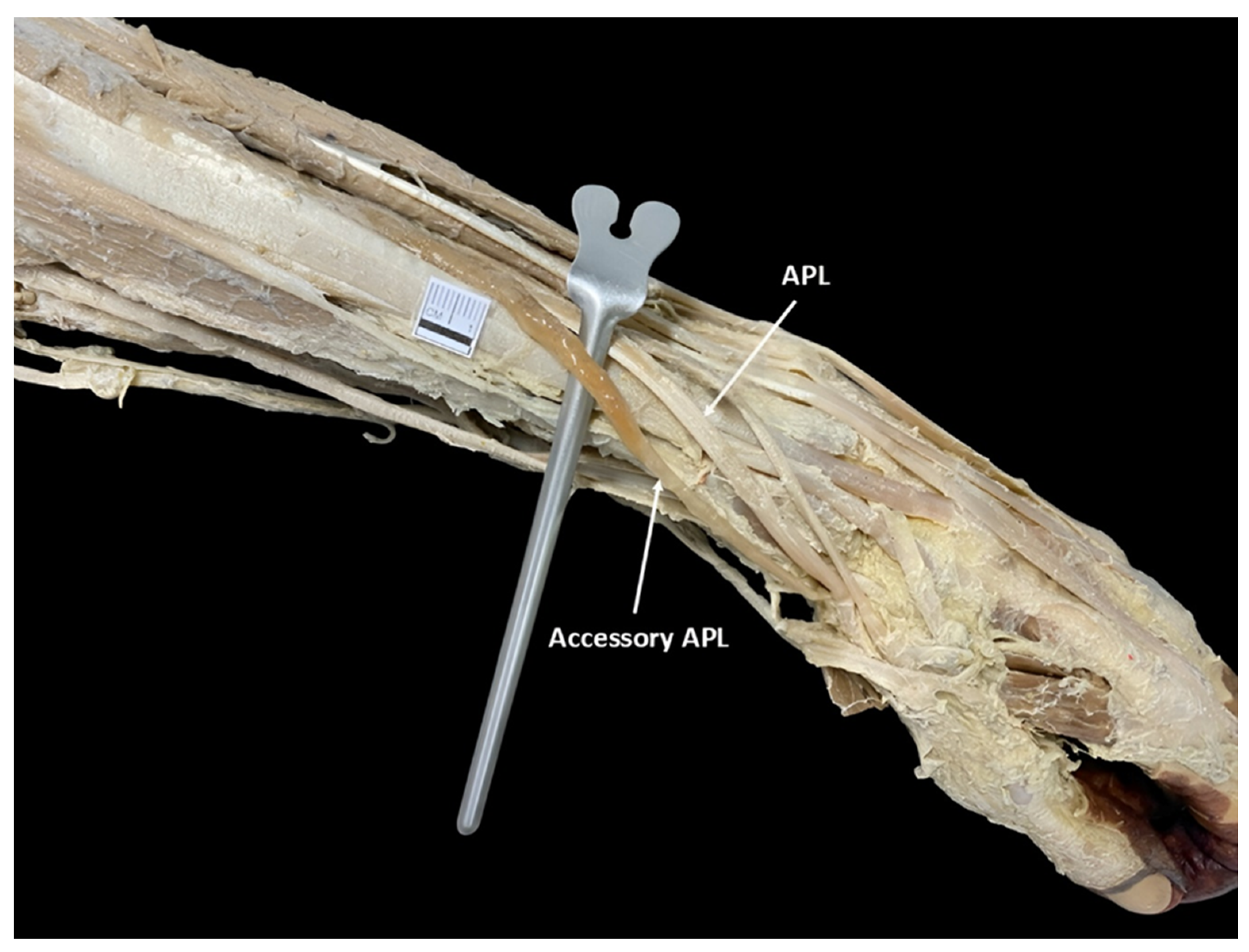 Prevalence, Morphometric Characteristics of the Accessory Abductor ...