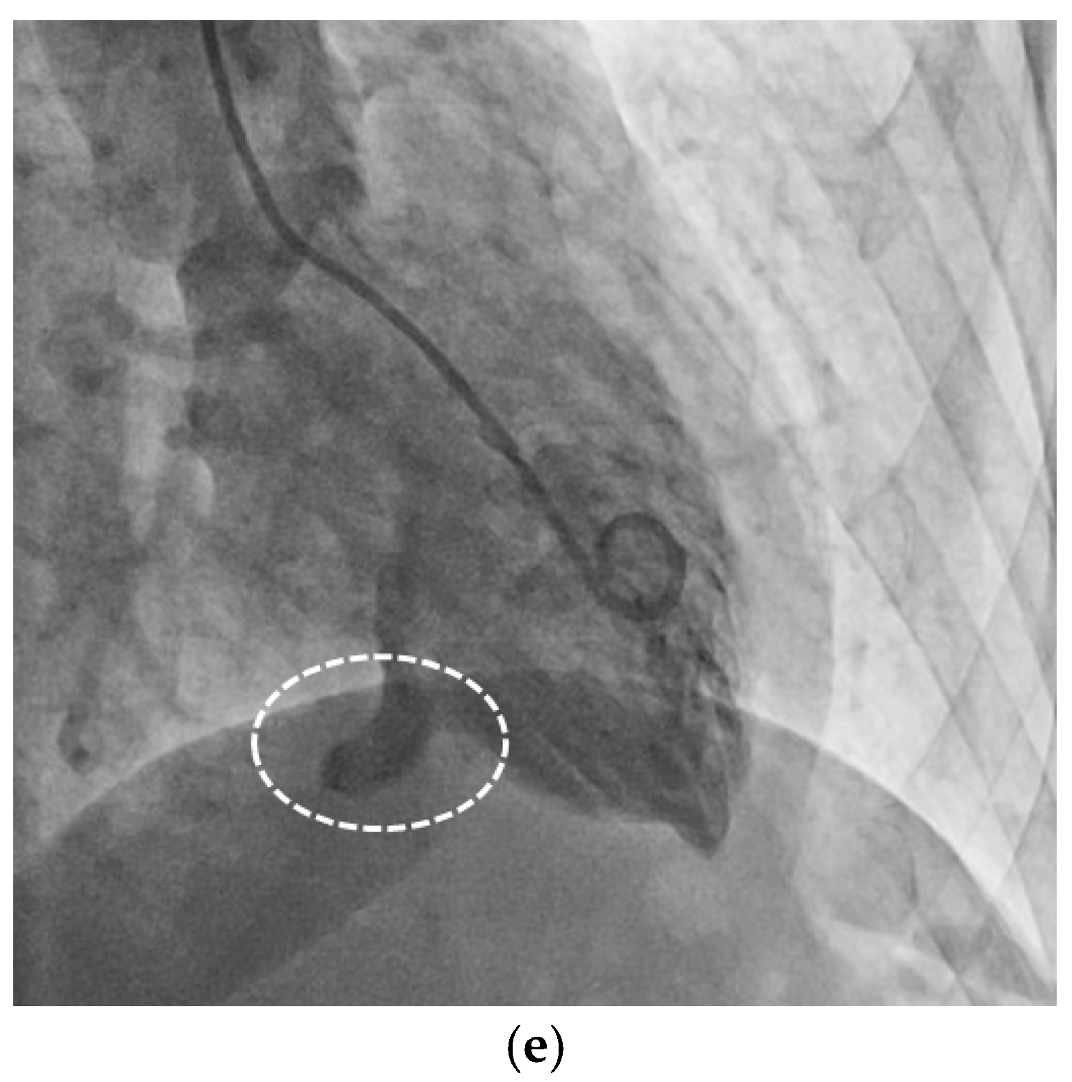 Interventricular Septum Diverticulum: A Multimodality Imaging Approach ...