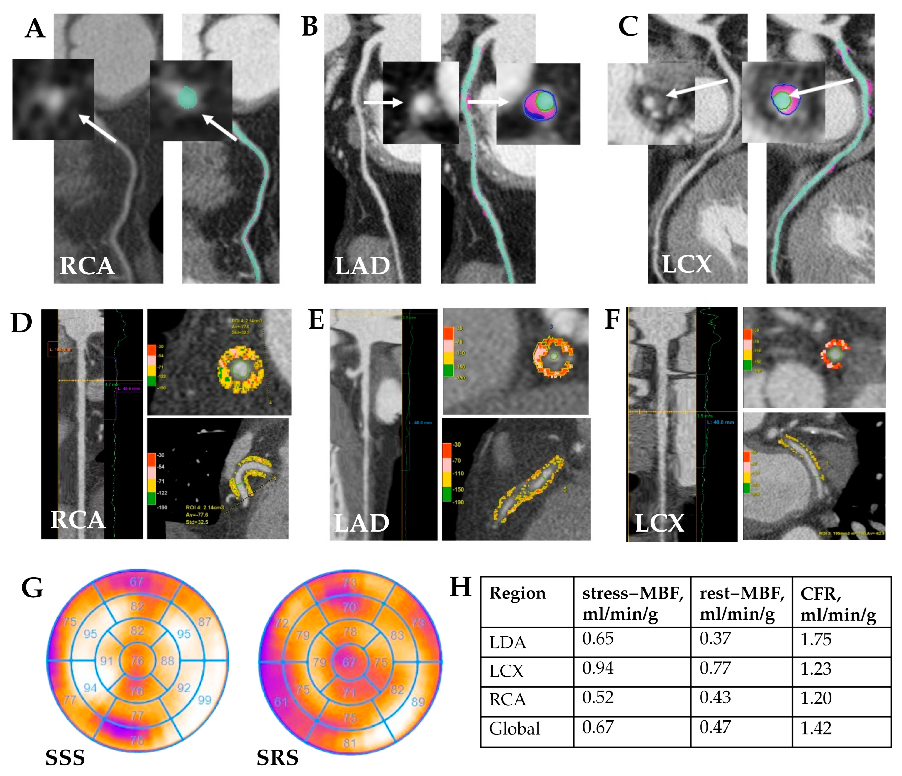 Quantitative Coronary CT Angiography and Pericoronary Adipose Tissue in ...