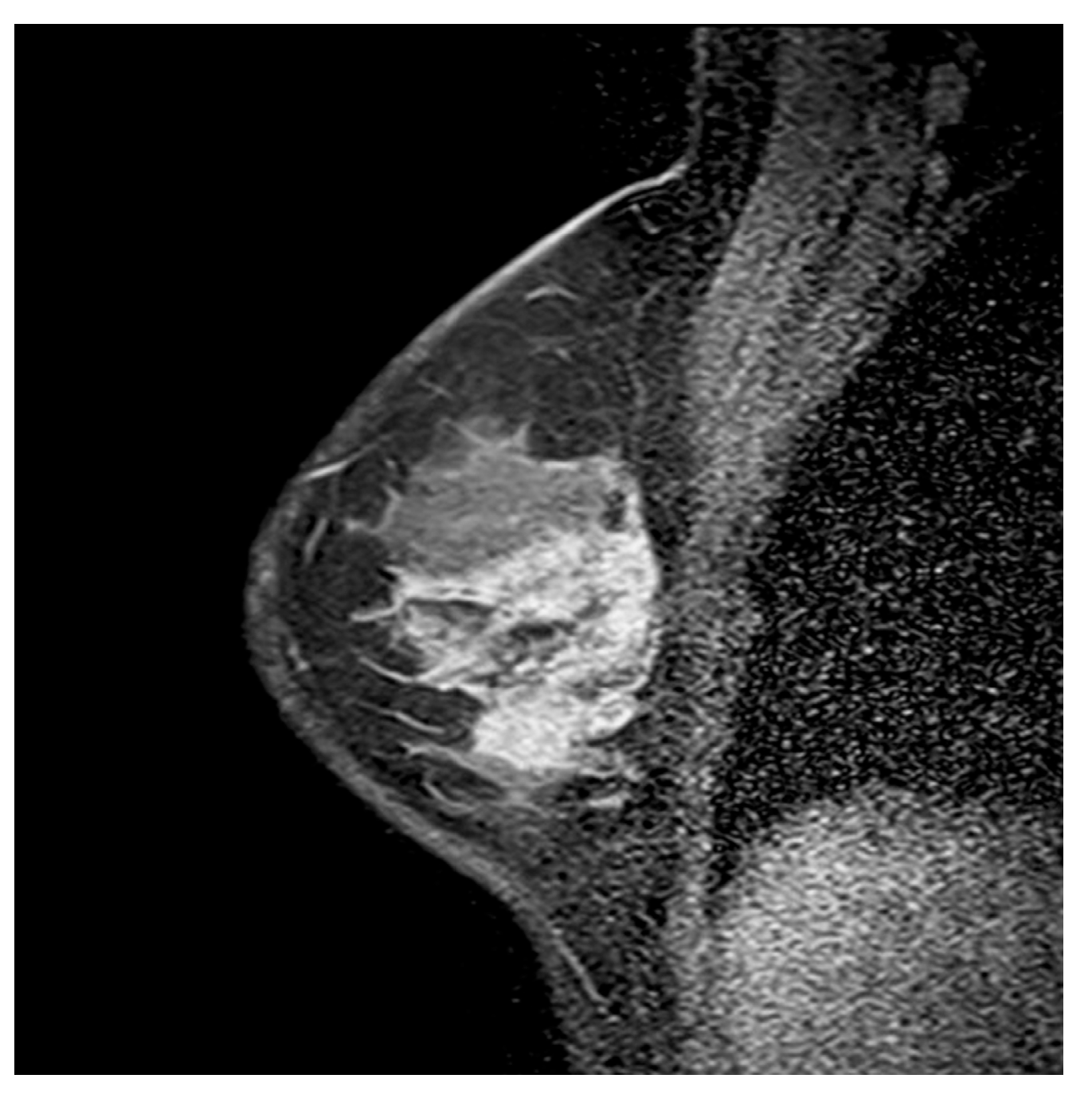 Segmental Non-Mass Enhancement Features in Breast Magnetic Resonance ...