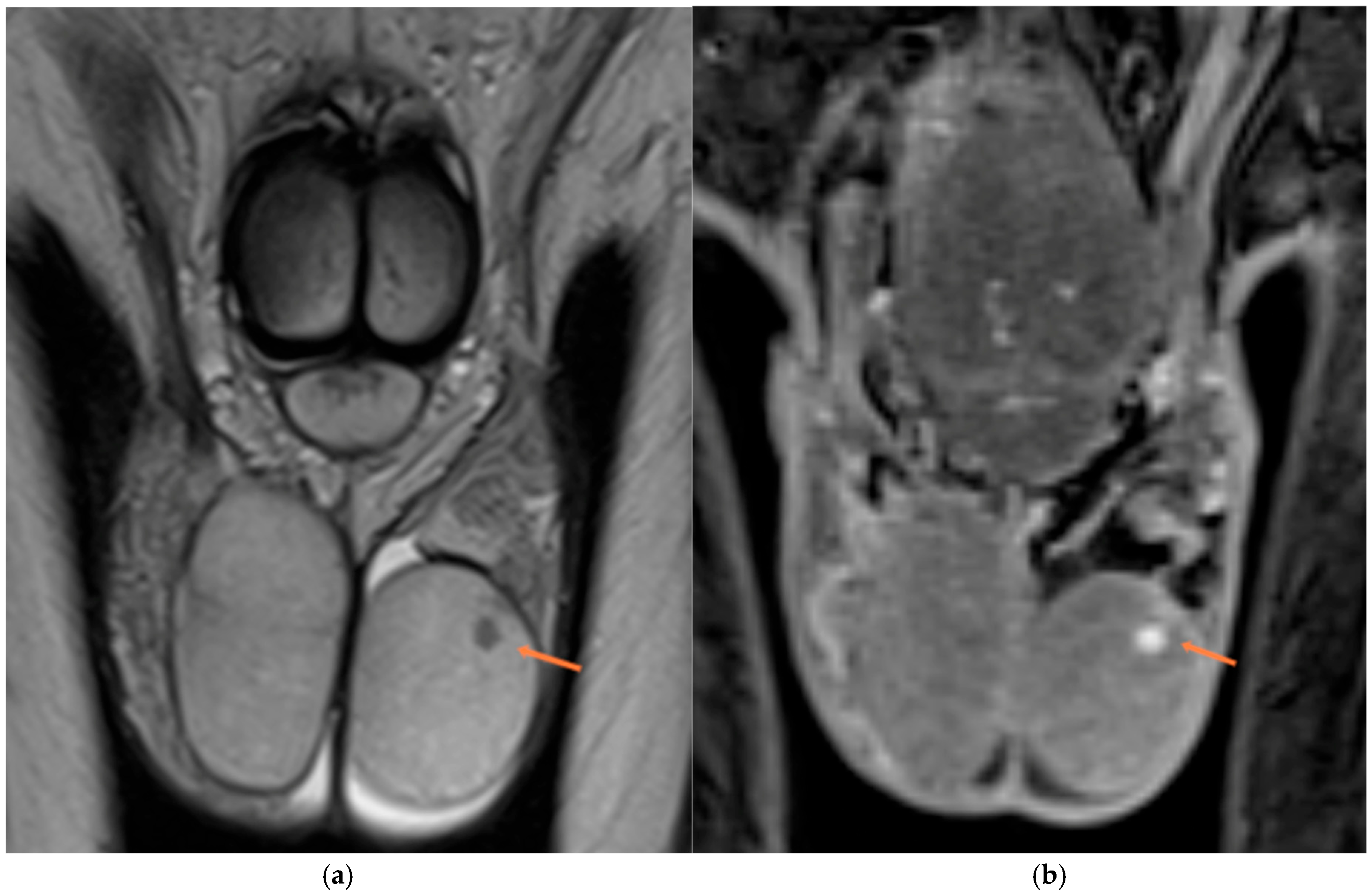 MRI of the Scrotum and Penis: Current Applications and Clinical ...