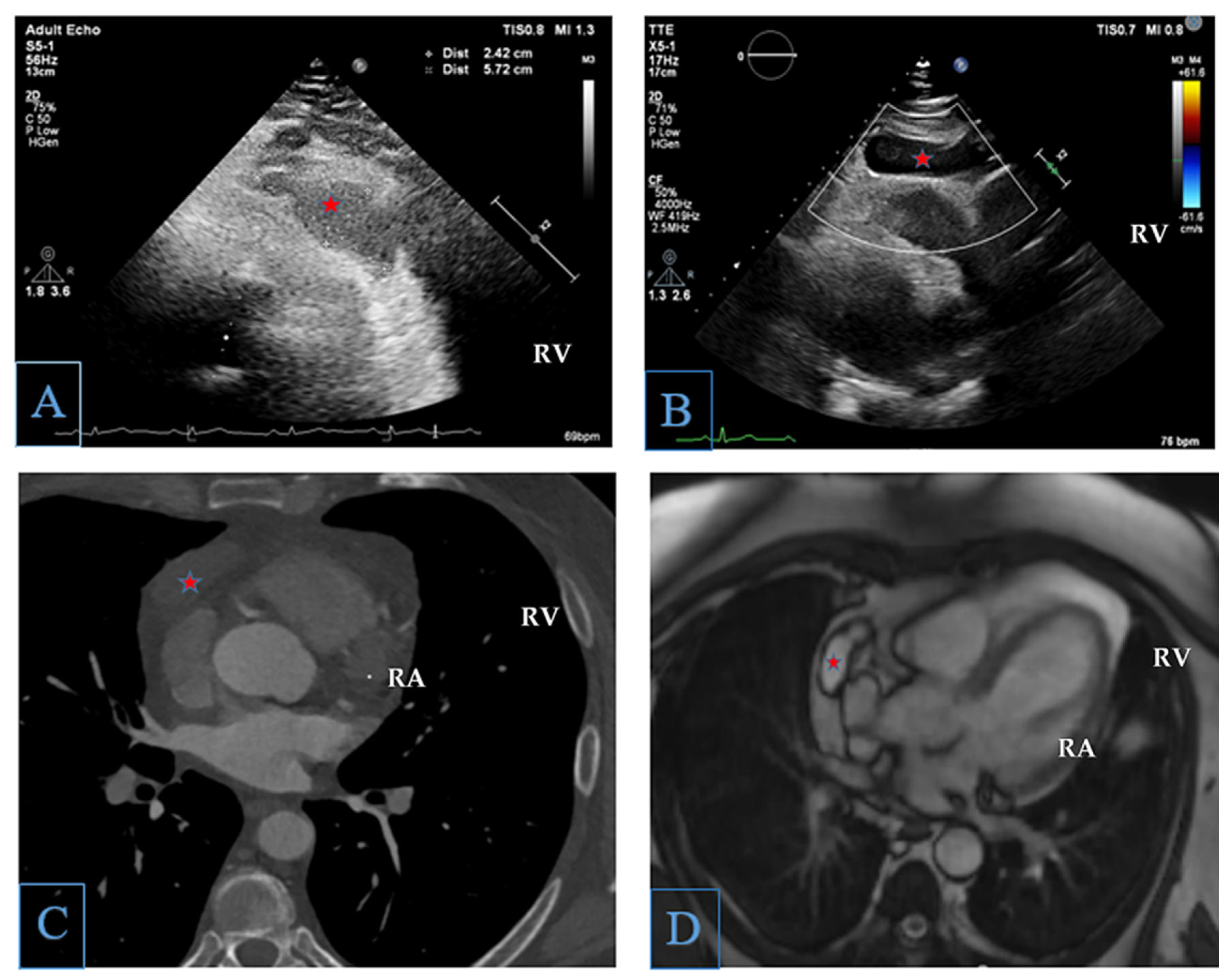 Right-Ventricle-Adjacent Mass: A Multimodality Imaging Approach to ...