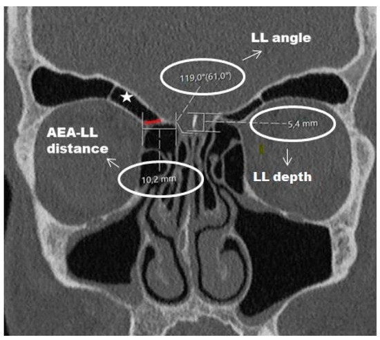 Multidimensional Morphology of the Ethmoid Roof and Anterior Ethmoidal ...