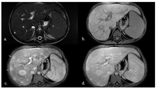 Hepatic Vascular Involvement in Adenosine Deaminase 2 Deficiency (DADA2 ...