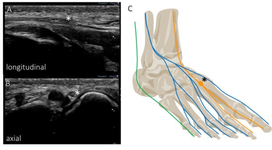 Thickening of Dorsal Foot Nerves: A Frequent Sonographic Finding in ...