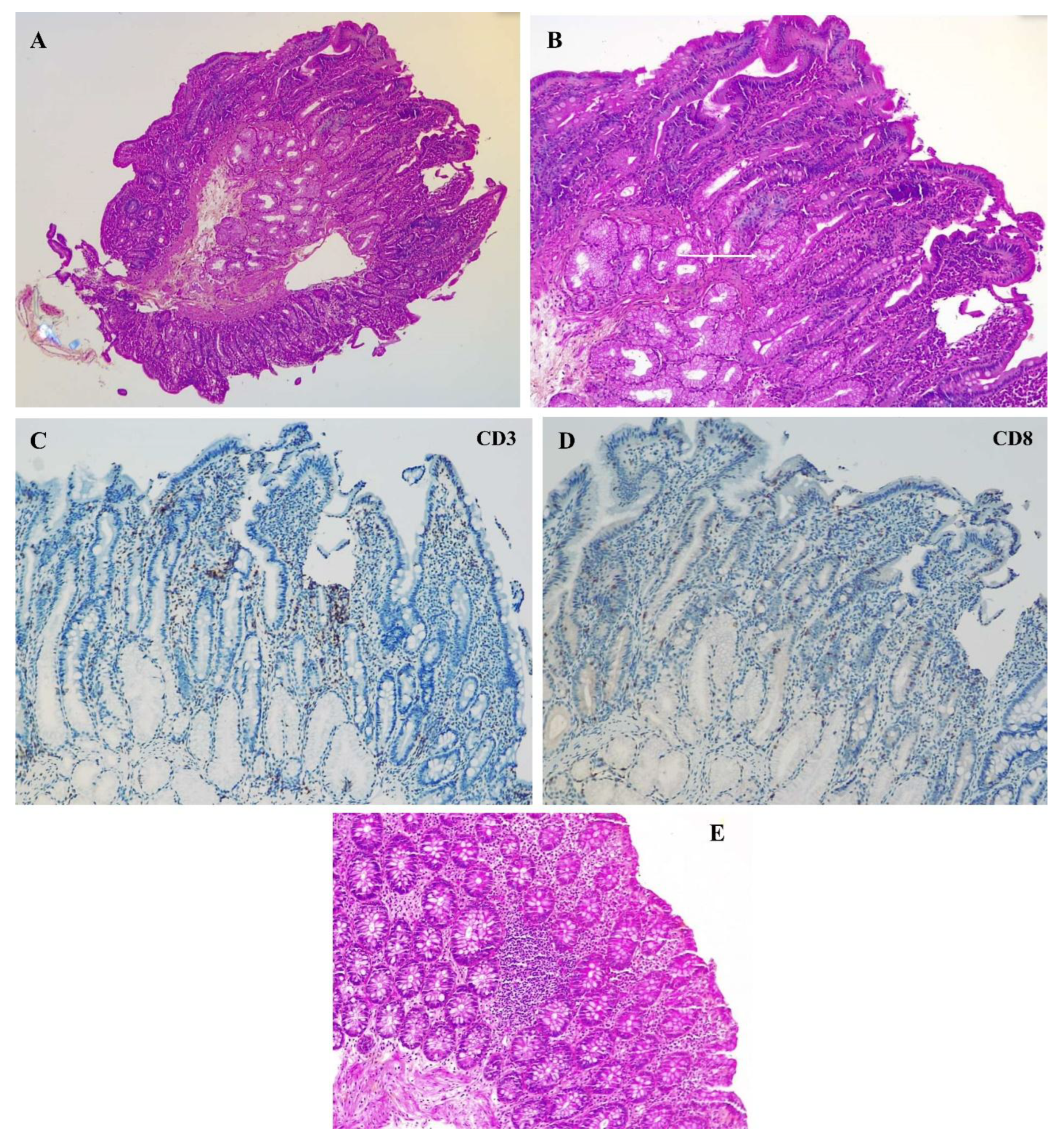 Atypical Rapid Onset of Olmesartan-Induced Enteropathy with Recurrence ...