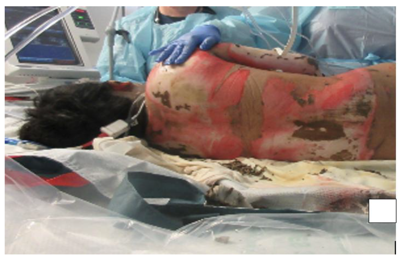 Comprehensive Management of Severe Burn Injuries: A Multidisciplinary ...