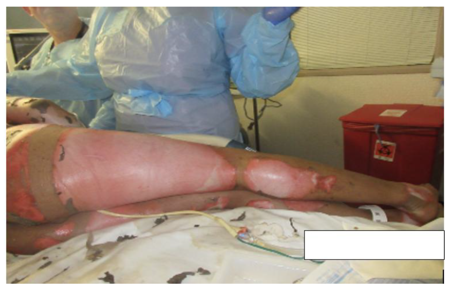 Comprehensive Management of Severe Burn Injuries: A Multidisciplinary ...
