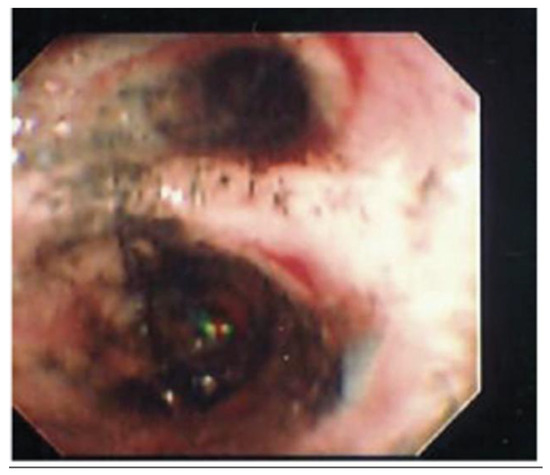 Comprehensive Management of Severe Burn Injuries: A Multidisciplinary ...