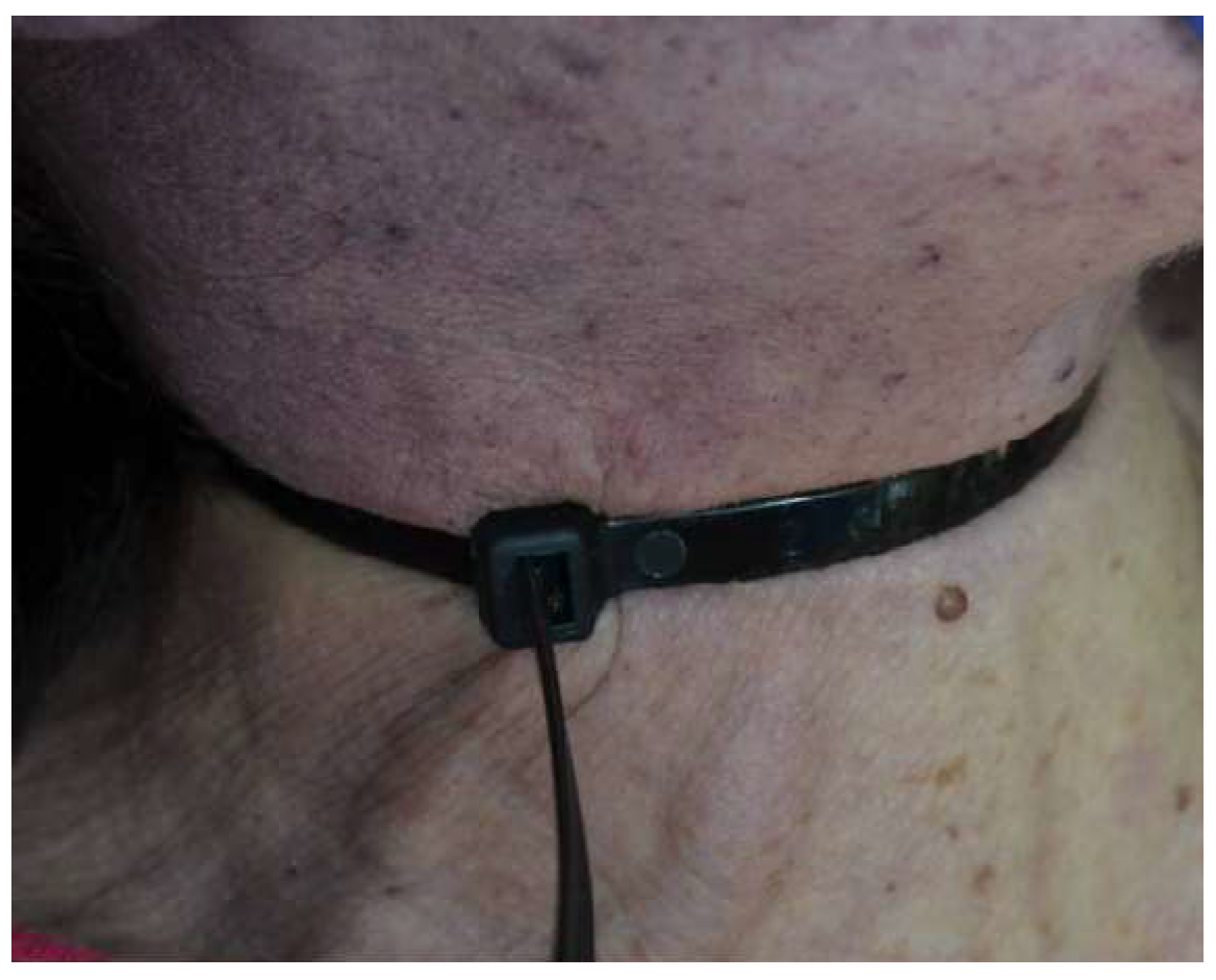 Strangulation Using Cable Ties and a Suicidal Manner of Death: A Case Report and Literature ...