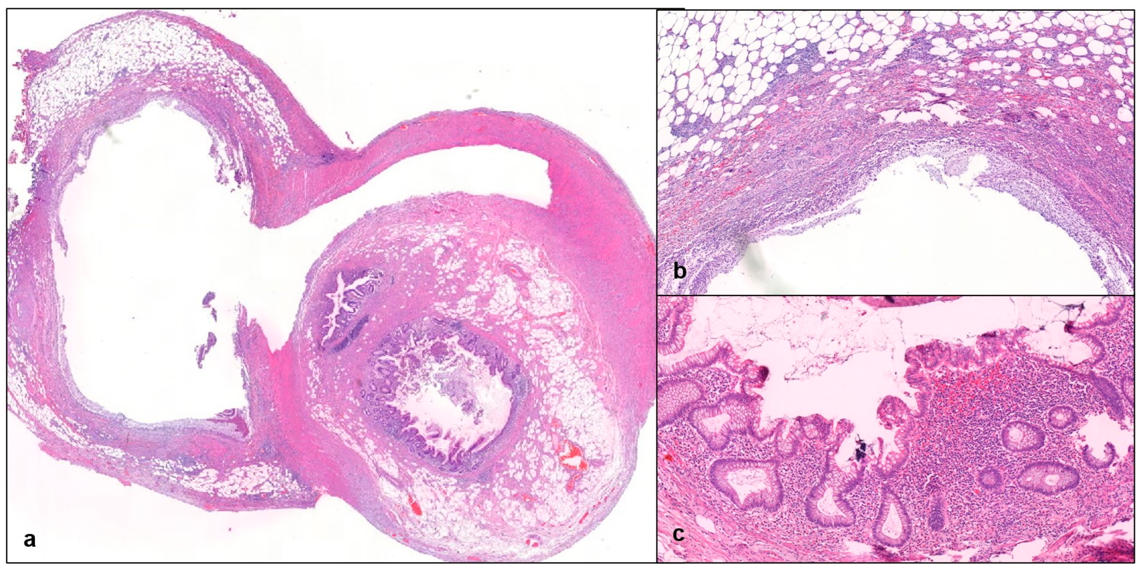 Low-Grade Appendiceal Mucinous Neoplasm vs. Appendiceal Diverticulum ...