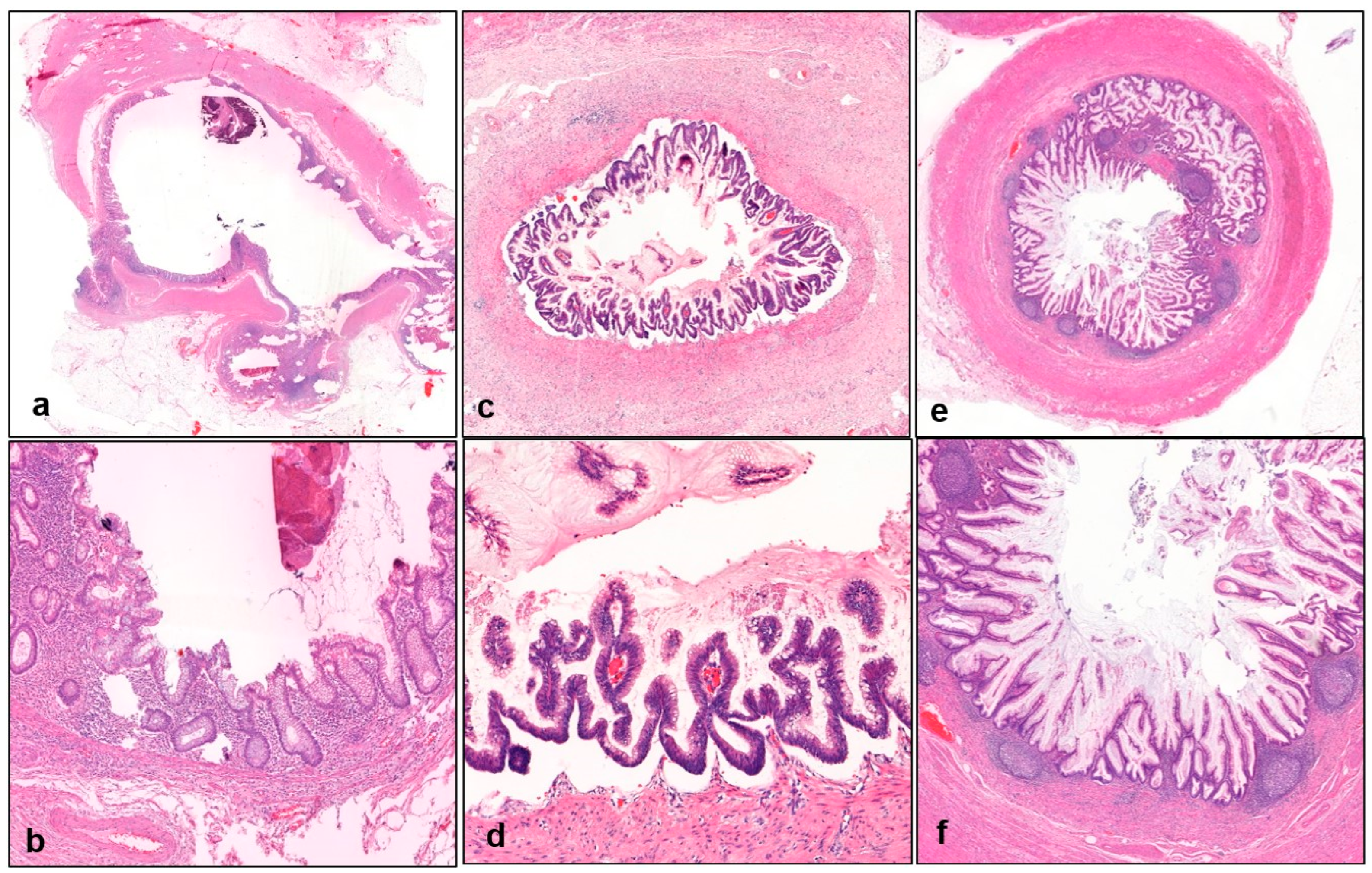 Low-Grade Appendiceal Mucinous Neoplasm vs. Appendiceal Diverticulum ...