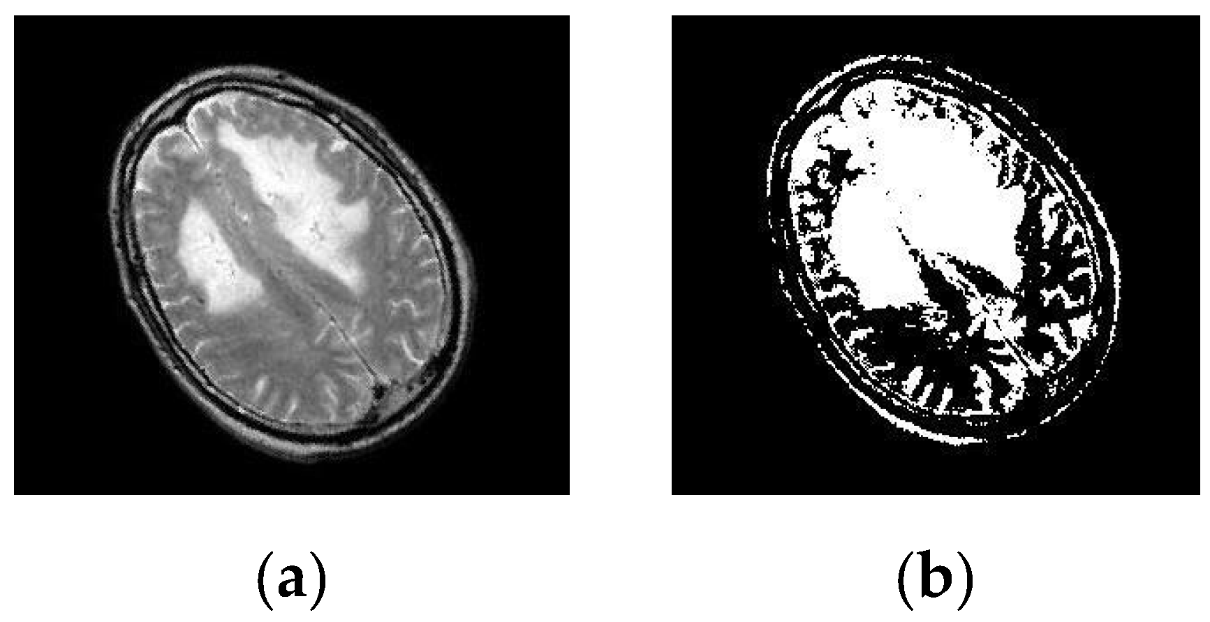 Cancerous and Non-Cancerous Brain MRI Classification Method Based on ...