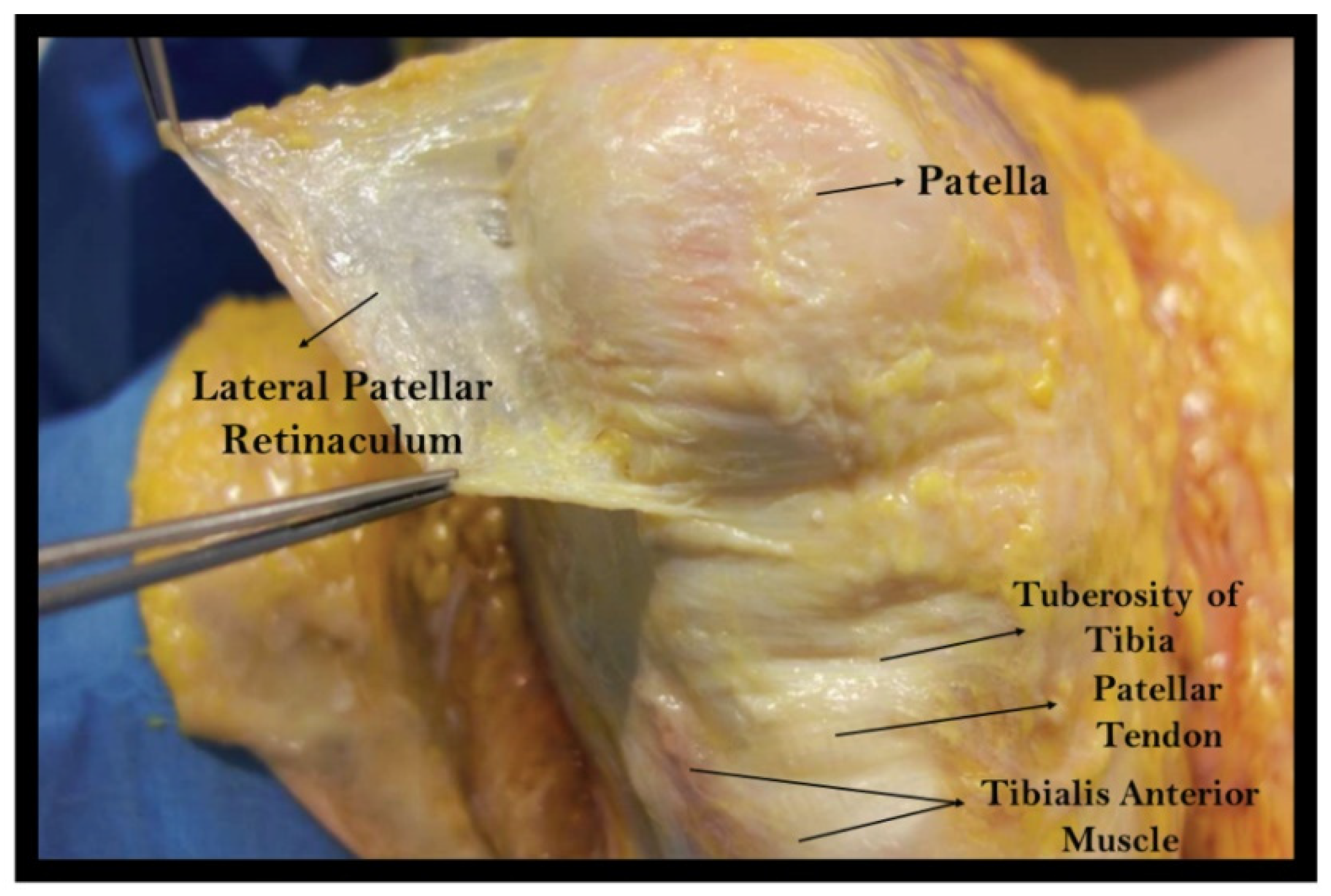 Are Patellofemoral Ligaments and Retinacula Distinct Structures of the ...