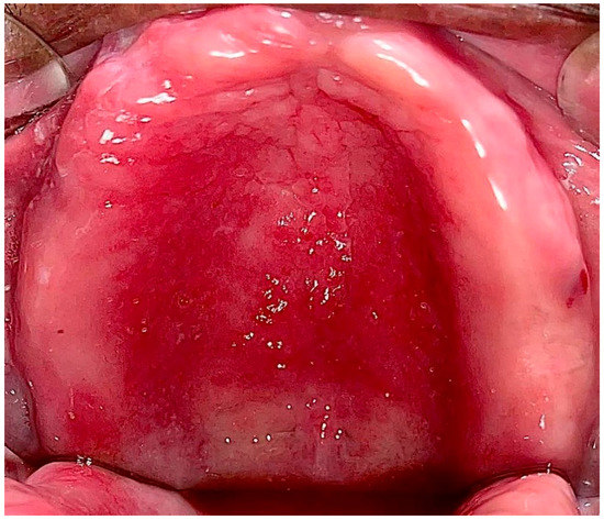 Management of Chronic Atrophic Candidiasis (Denture Stomatitis)—A ...