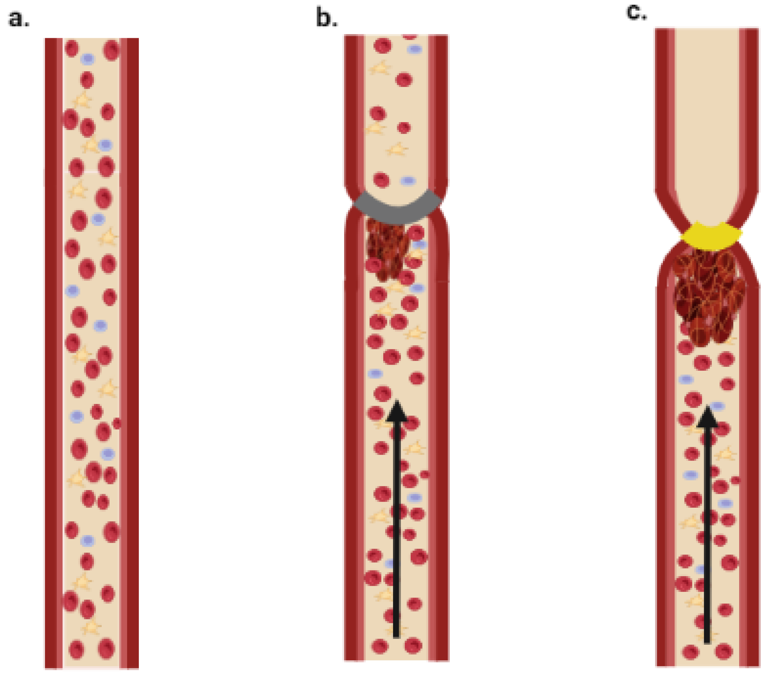 Thrombosis Models: An Overview of Common In Vivo and In Vitro Models of ...