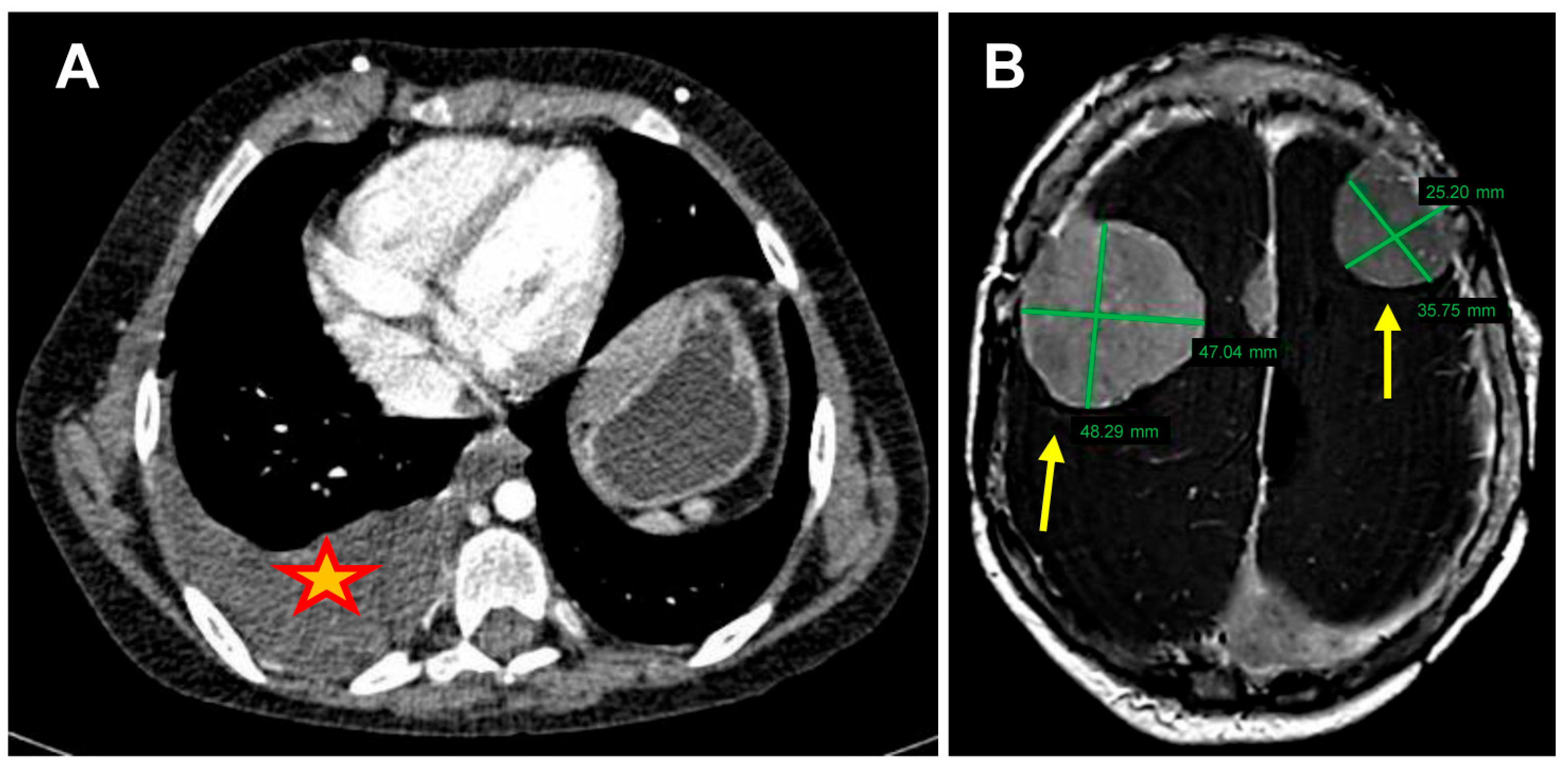 Genetic Landscape of a Pleural Mesothelioma in a Child Affected by NF2 ...