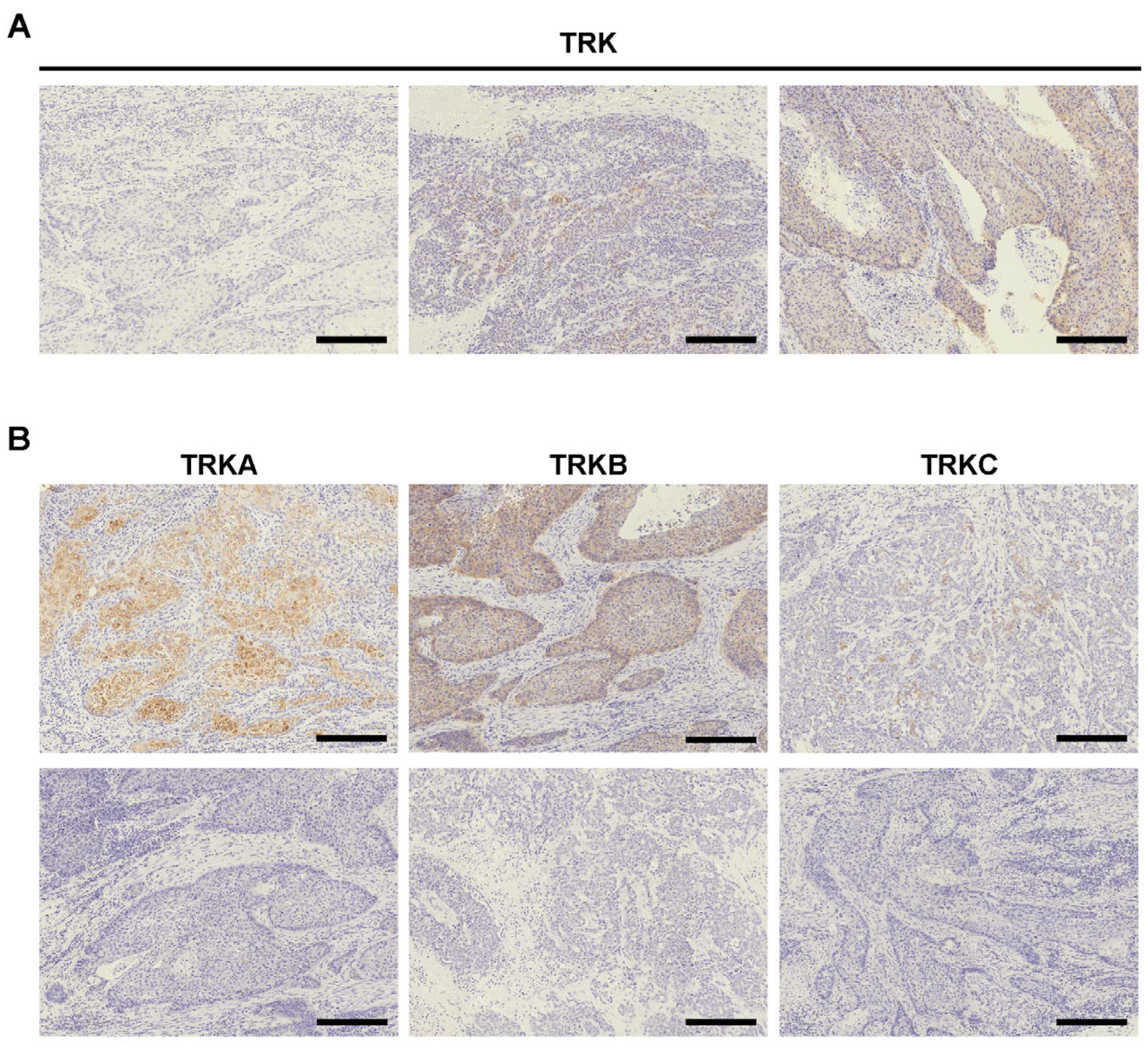 Evaluation of NTRK Fusions Detection Method in Esophageal Squamous Cell ...