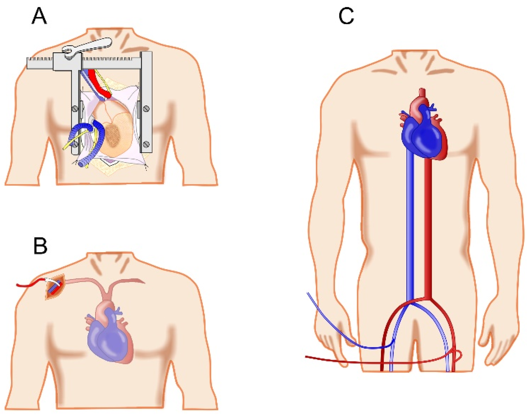 The Management of the Aortic Arch in Type A Aortic Dissection: Replace ...