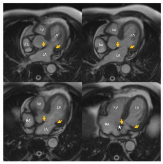Mitral Annular Calcification, a Not So Marginal and Relatively Benign ...