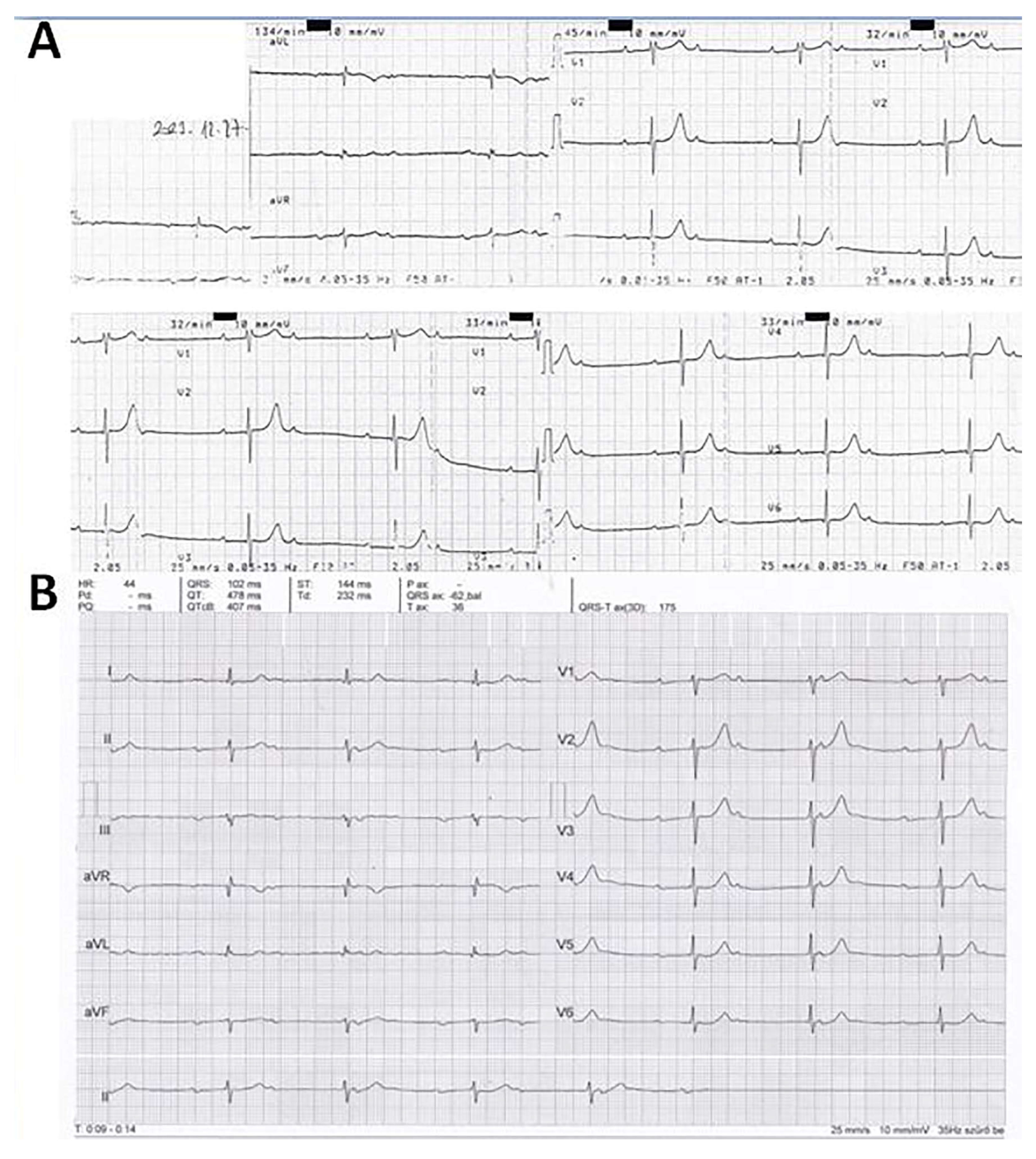 Mitral Annular Calcification, a Not So Marginal and Relatively Benign ...