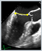 Echocardiographic Assessment of Patients Undergoing Mitral Valve Repair ...