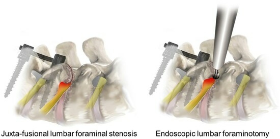 Transforaminal Endoscopic Lumbar Foraminotomy for Juxta-Fusional ...