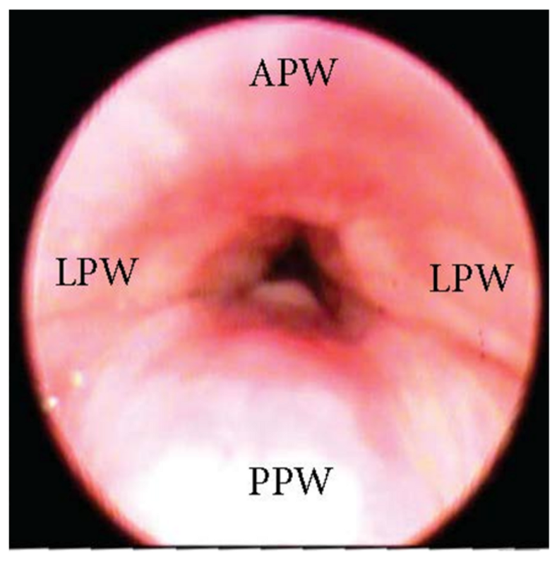 A Critical Analysis of Pharyngeal Patterns of Collapse in Obstructive ...