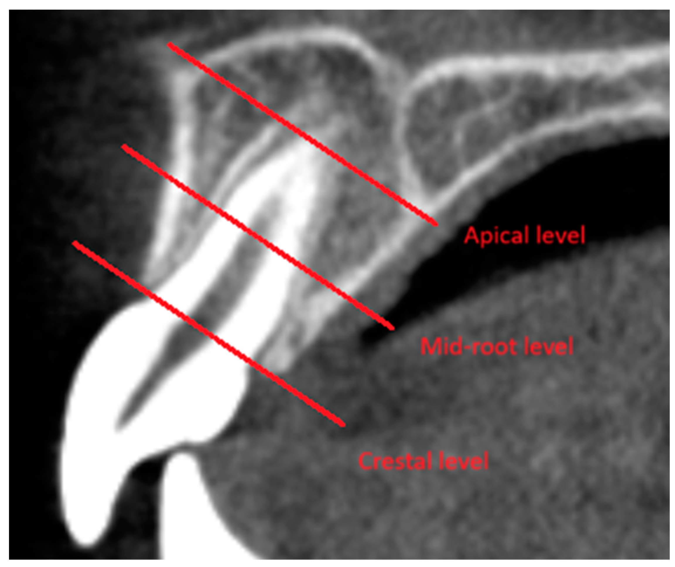 Bone Remodeling of Maxilla after Retraction of Incisors during ...