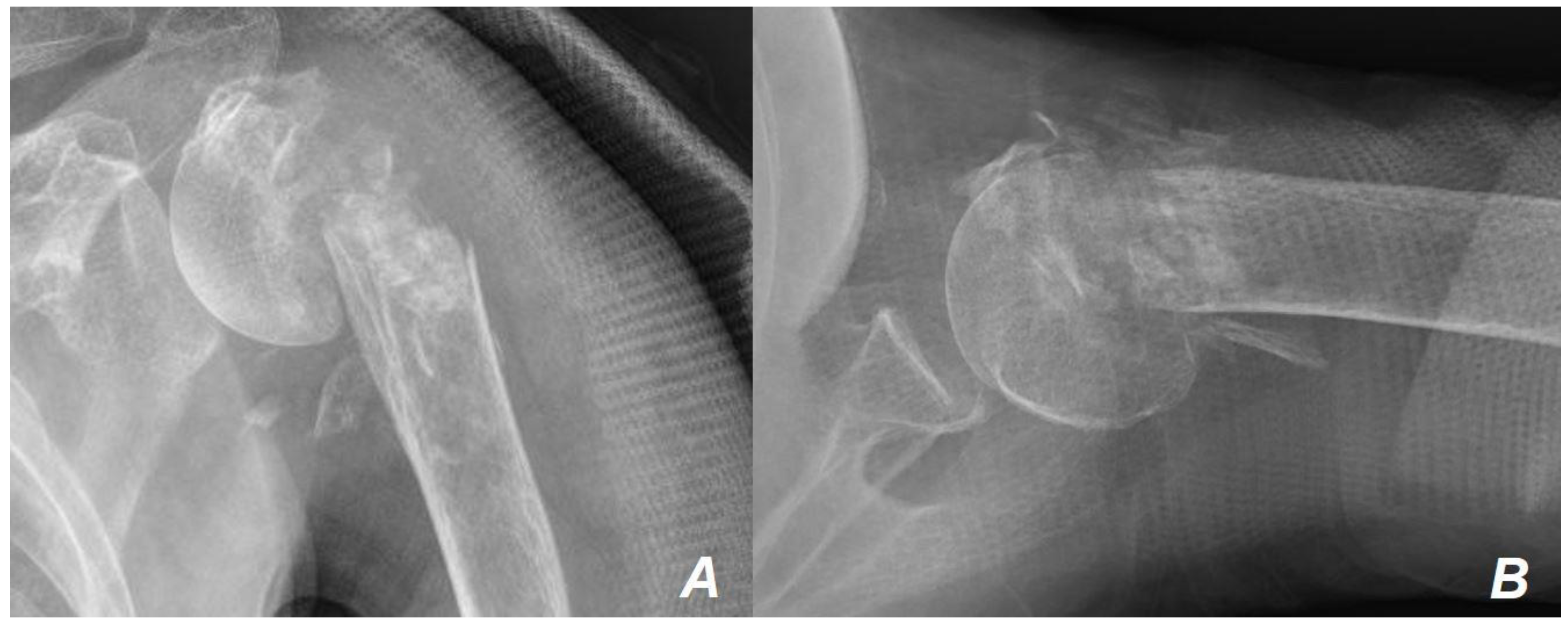 Novel Use of a Fibular Strut Allograft with Fibular Head in an Elderly ...