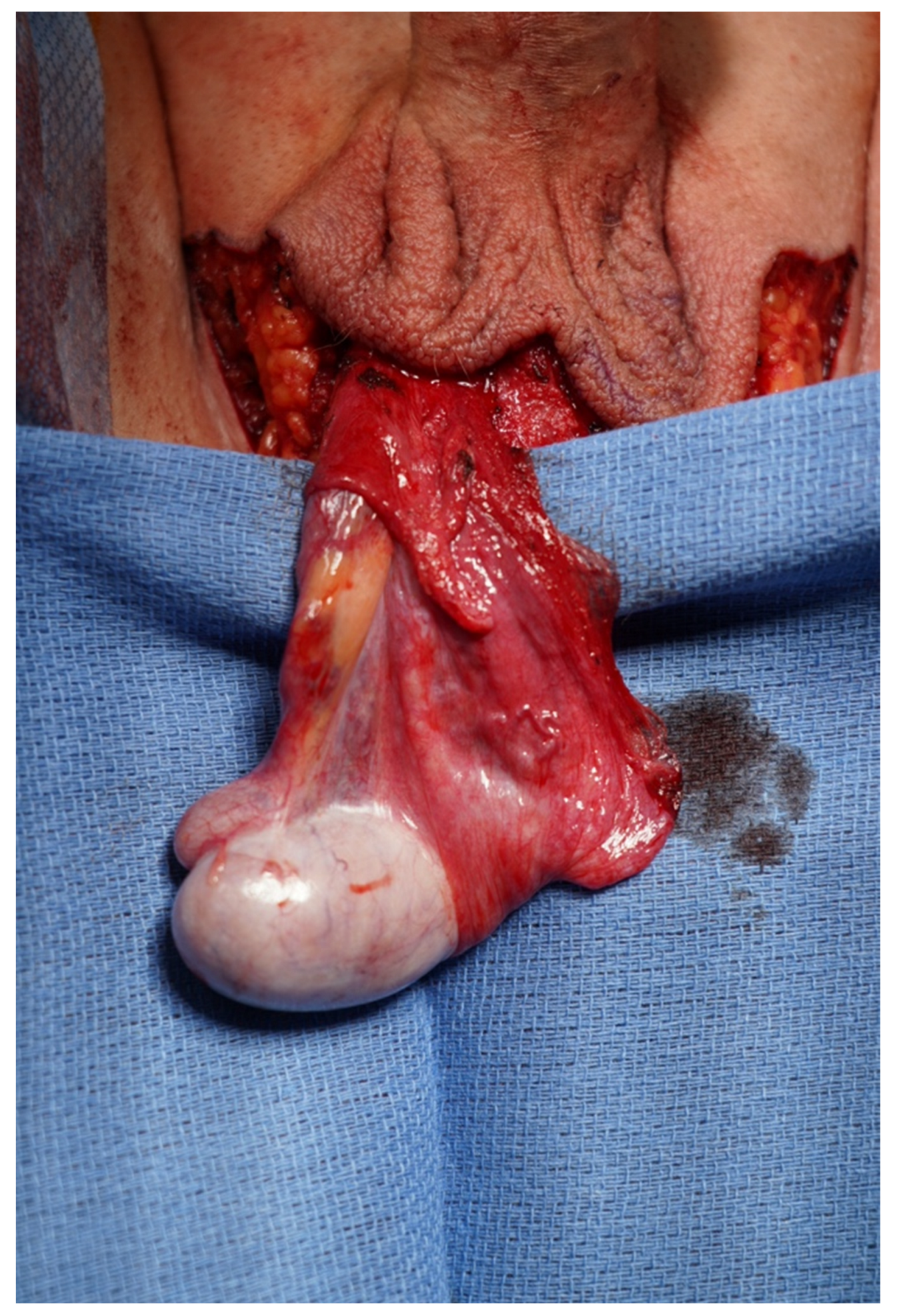 Tissue Options for Construction of the Neovaginal Canal in Gender ...