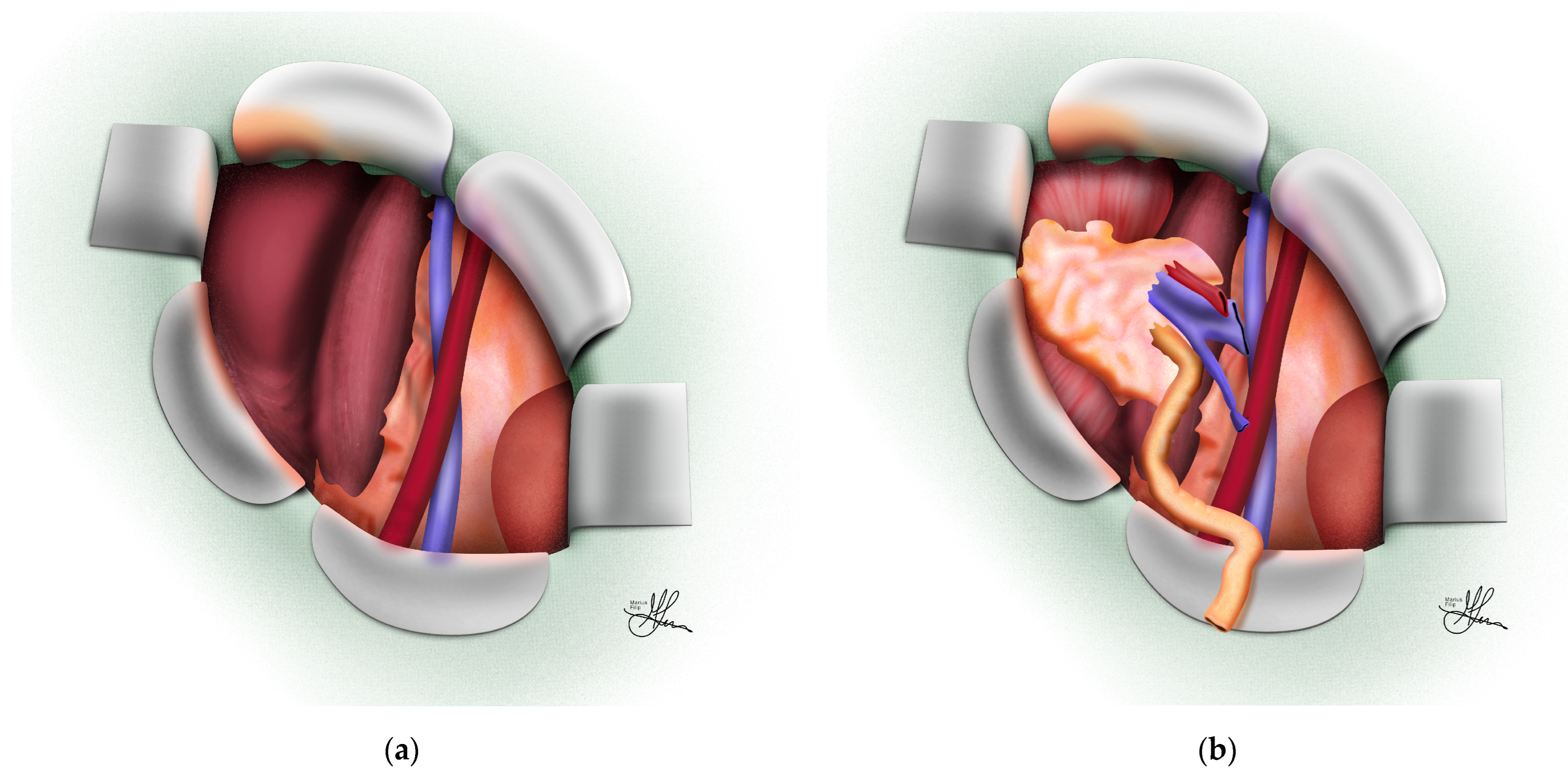 Surgical Strategies for Renal Transplantation: A Pictorial Essay | MDPI
