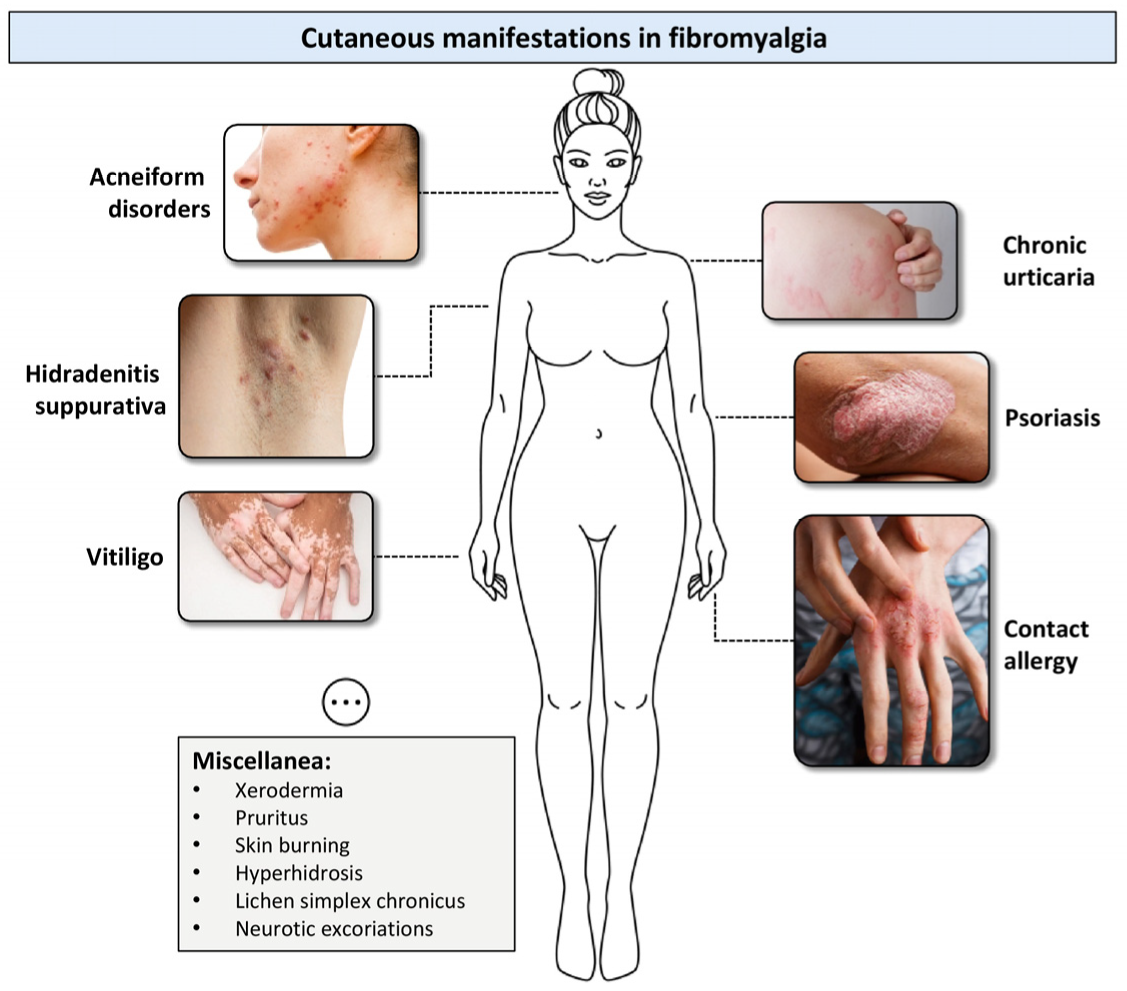 Fibromyalgia and Skin Disorders: A Systematic Review | MDPI