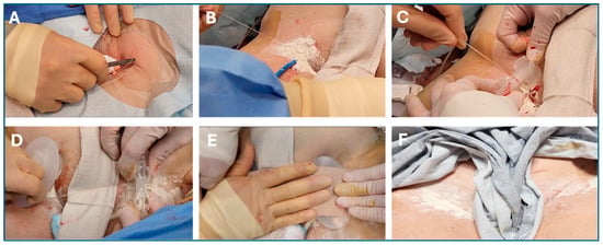 A Novel Suture-Based Vascular Closure Device to Achieve Hemostasis ...