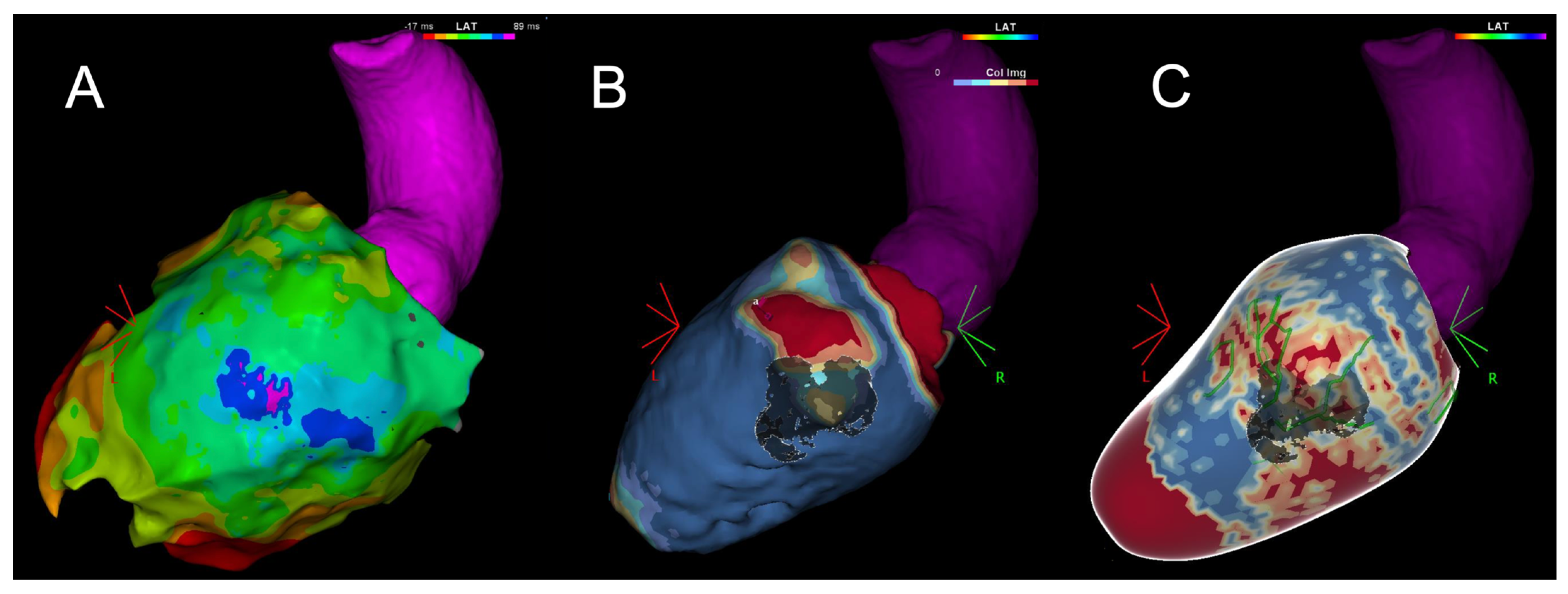 Approaching Ventricular Tachycardia Ablation in 2024: An Update on ...