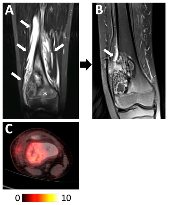Imaging of Osteosarcoma: Presenting Findings, Metastatic Patterns, and ...