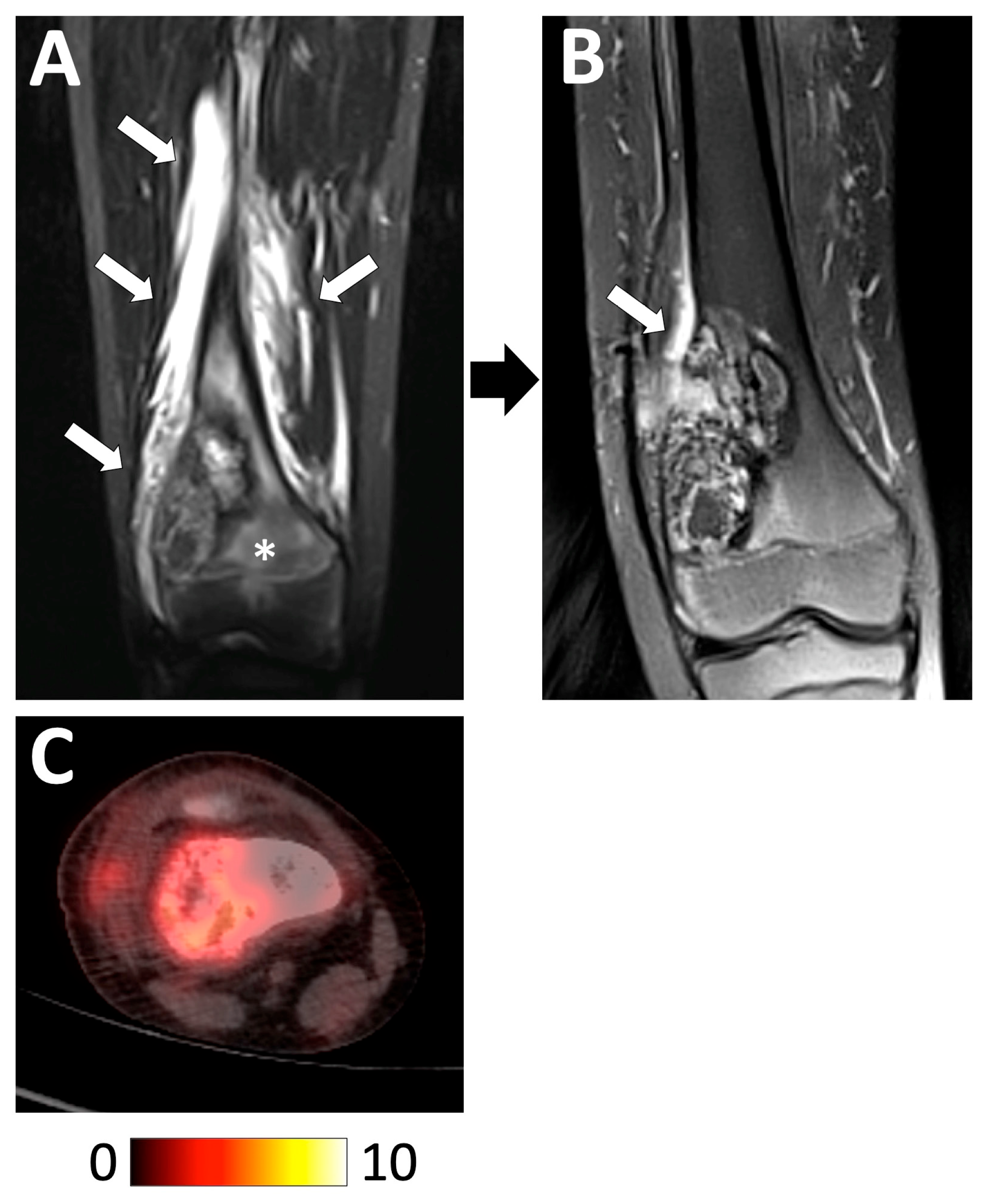 Imaging of Osteosarcoma: Presenting Findings, Metastatic Patterns, and ...