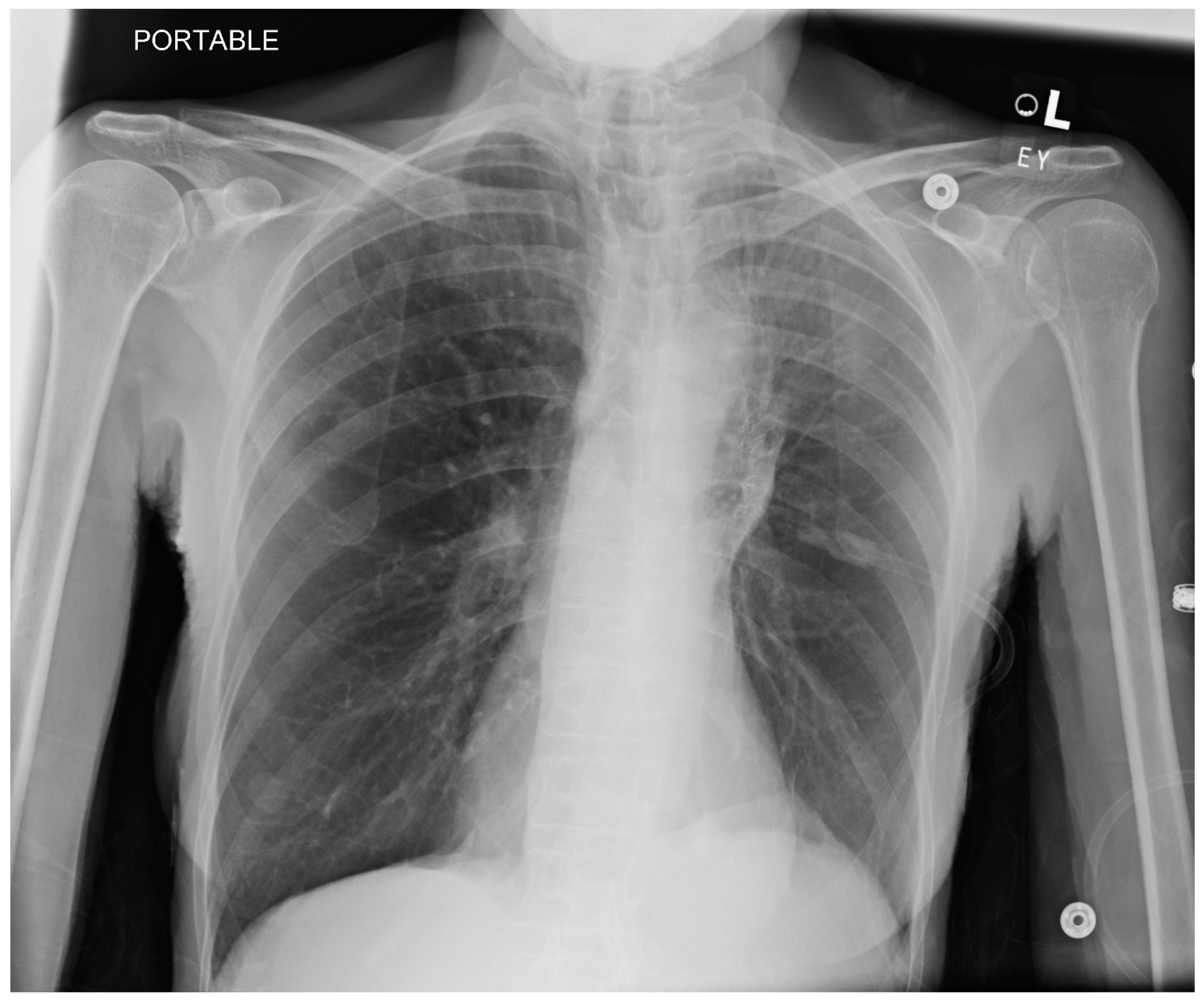 Anesthesia for Bronchoscopy—An Update | MDPI