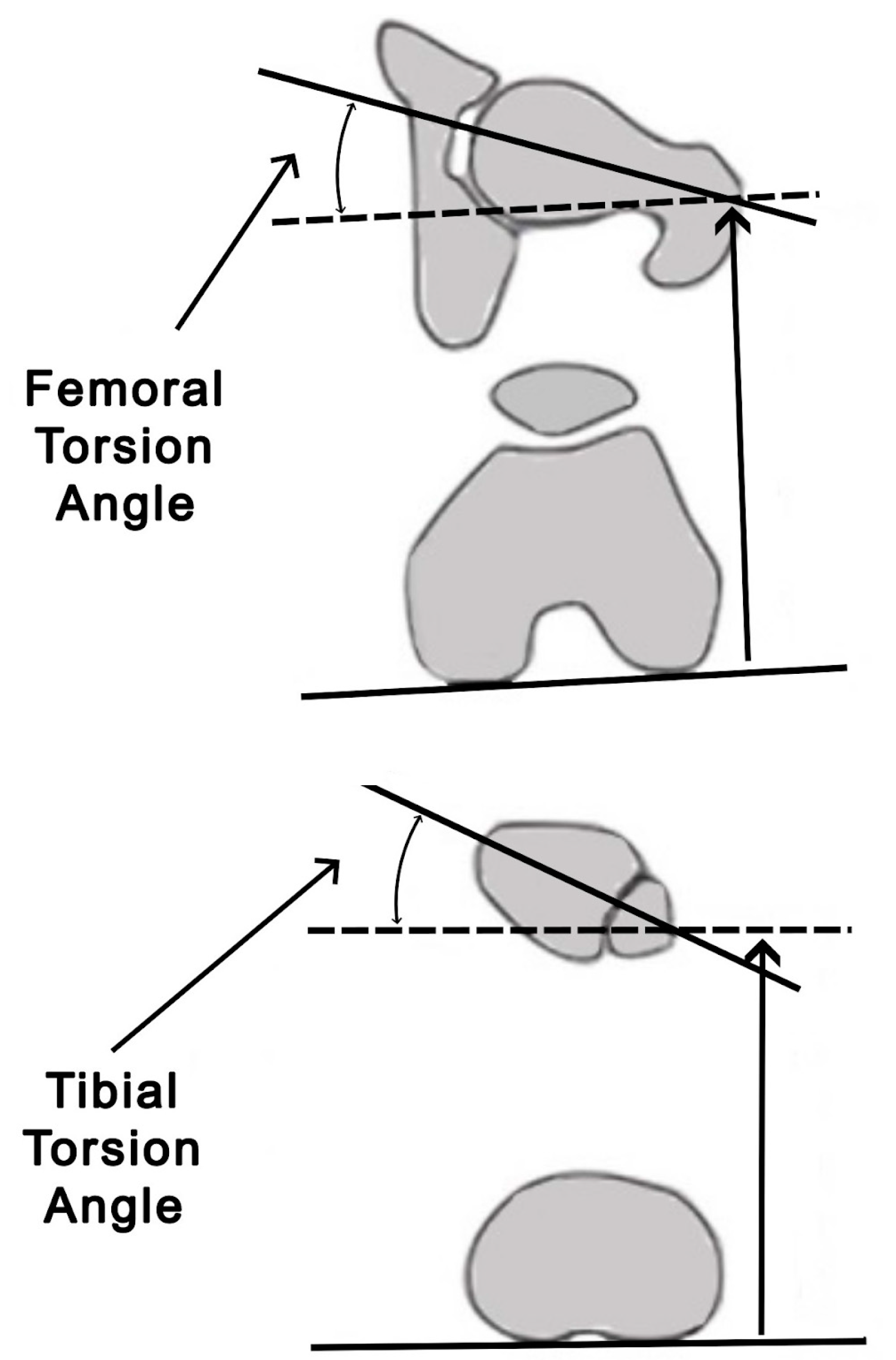 Radiological Approach to Assessment of Lower-Limb Alignment—Coronal and ...