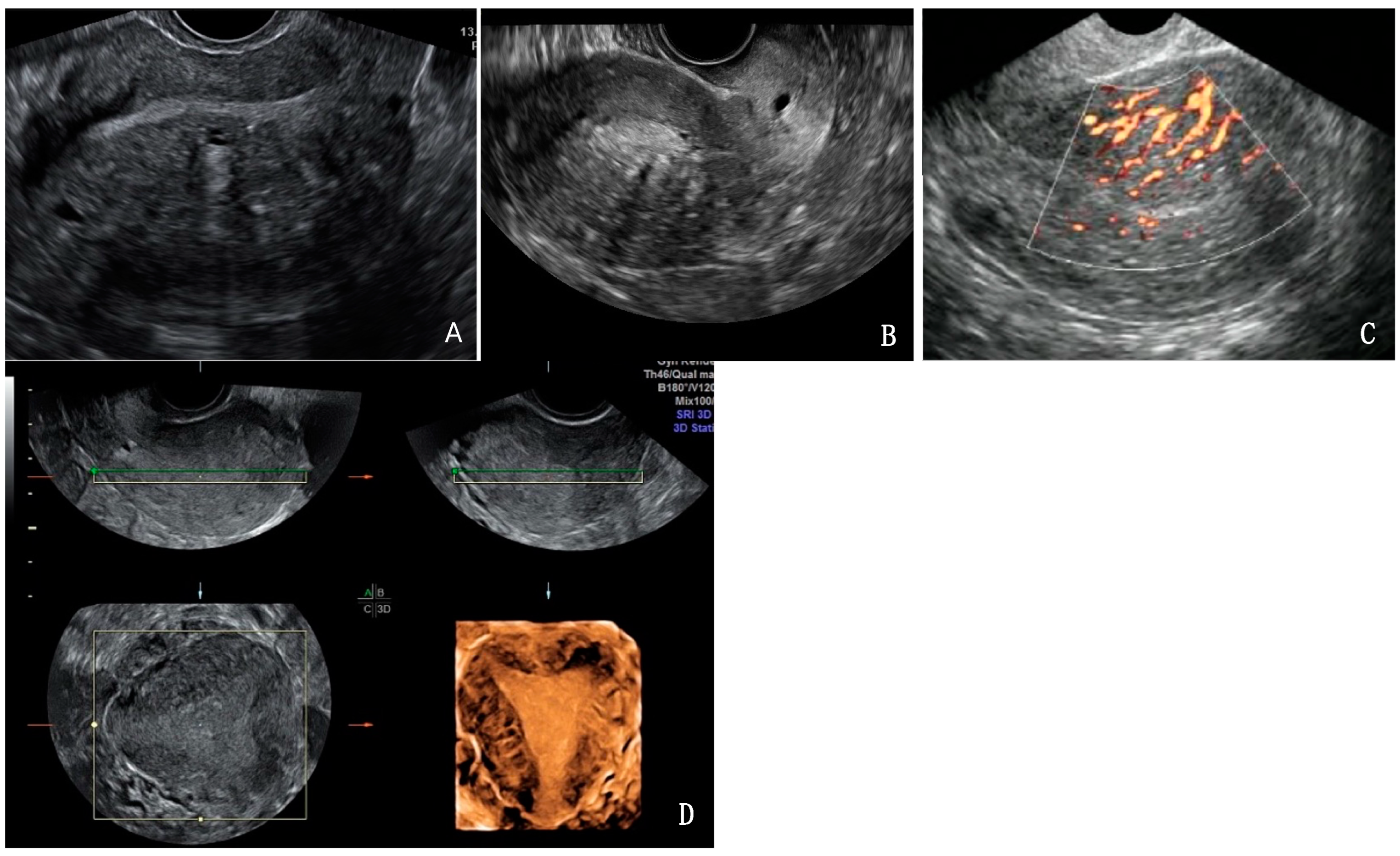 How Reproducible Are the Ultrasound Features of Adenomyosis Defined by ...