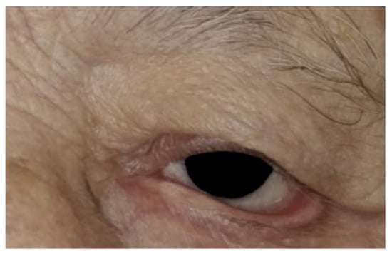 Ectropion Repair Techniques and the Role of Adjunctive Superotemporal ...