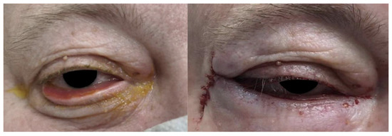 Ectropion Repair Techniques and the Role of Adjunctive Superotemporal ...