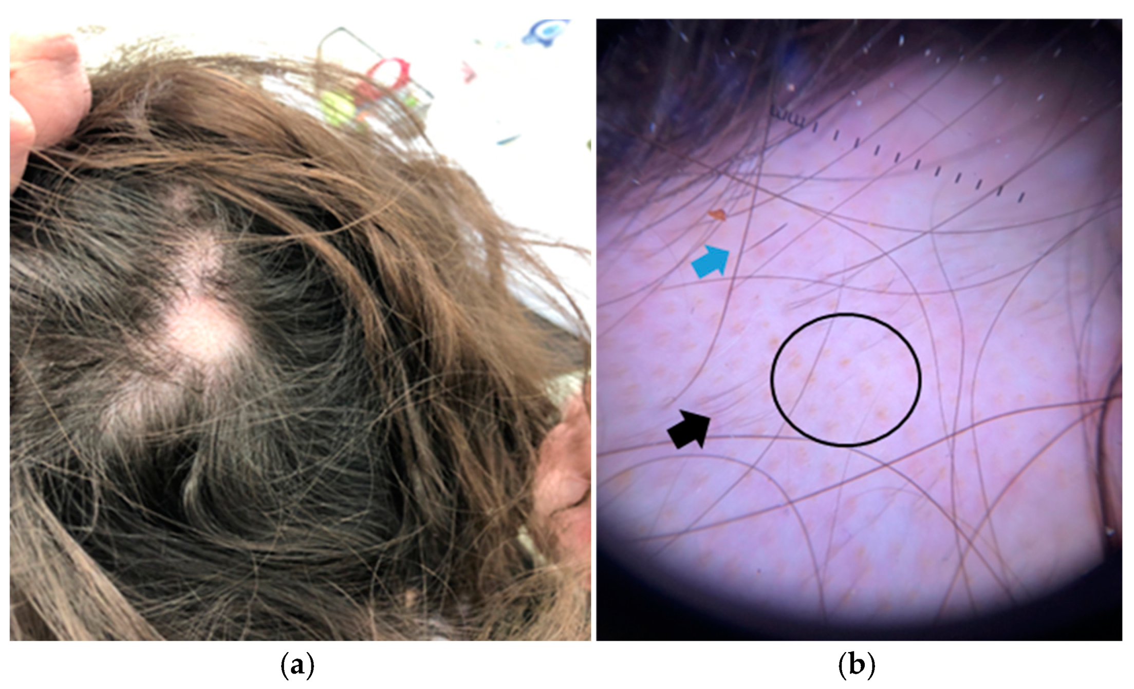 A Three-Step Diagnostic Algorithm for Alopecia: Pattern Analysis in ...