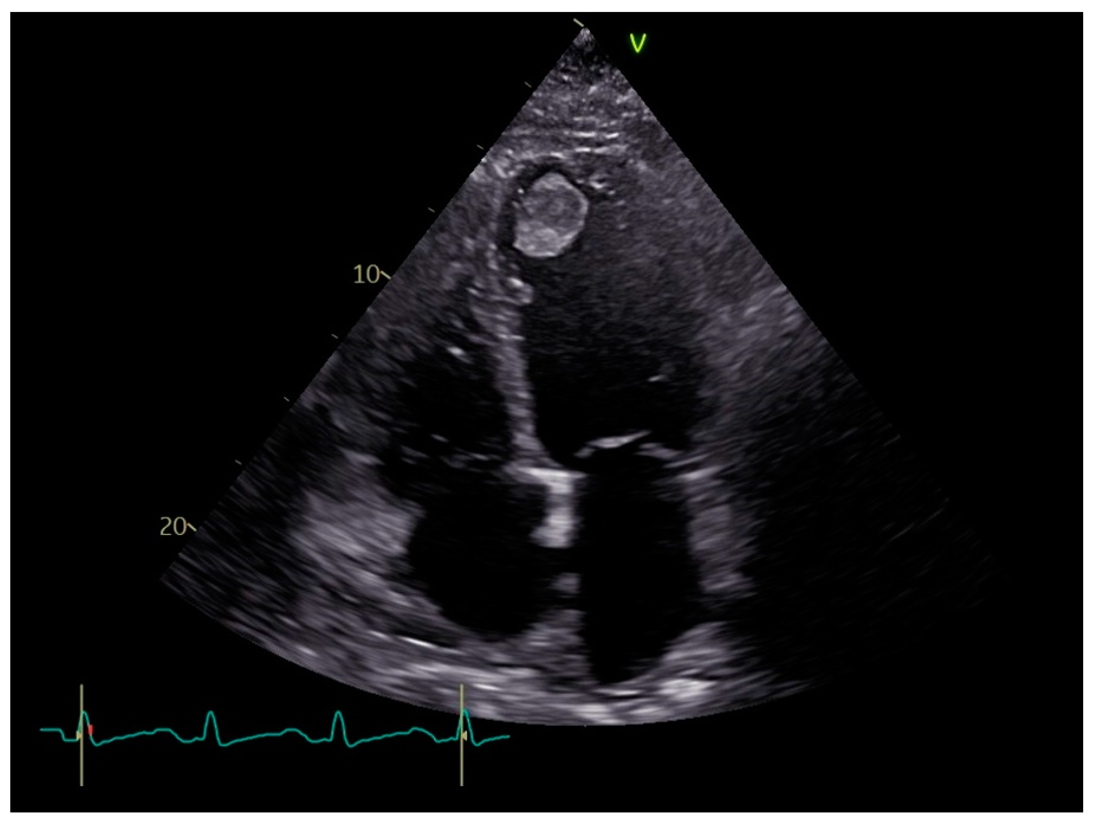 Left Ventricular Thrombosis in Ischemic and Non-Ischemic ...