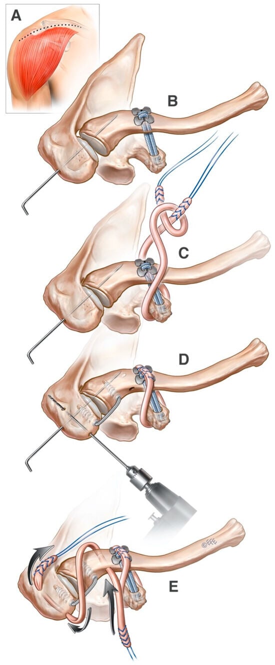 Combined Repair and Reconstruction of Coracoclavicular and ...