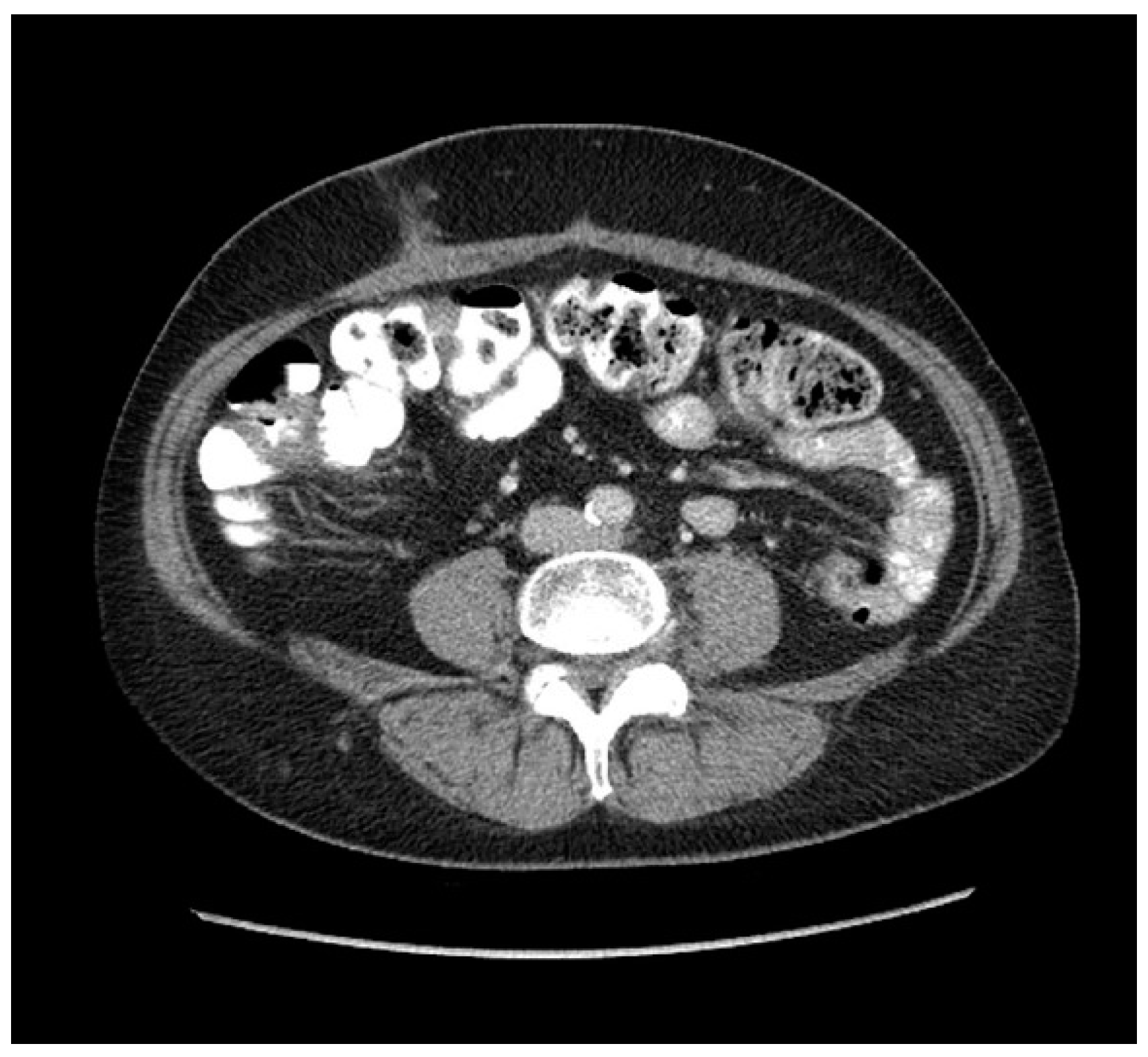 From Diversion to Permanence: Trends in Ostomy Creation in Rectal ...